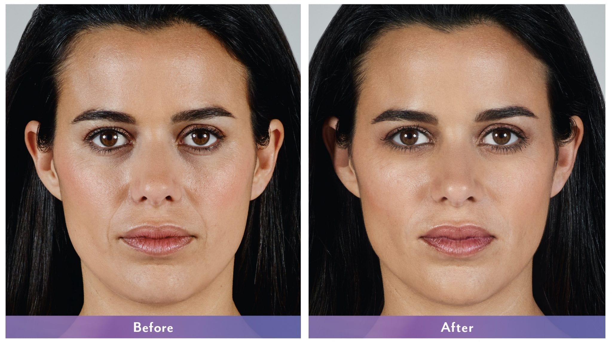 Juvederm Treatment | Vitality Integrative Skin Clinic