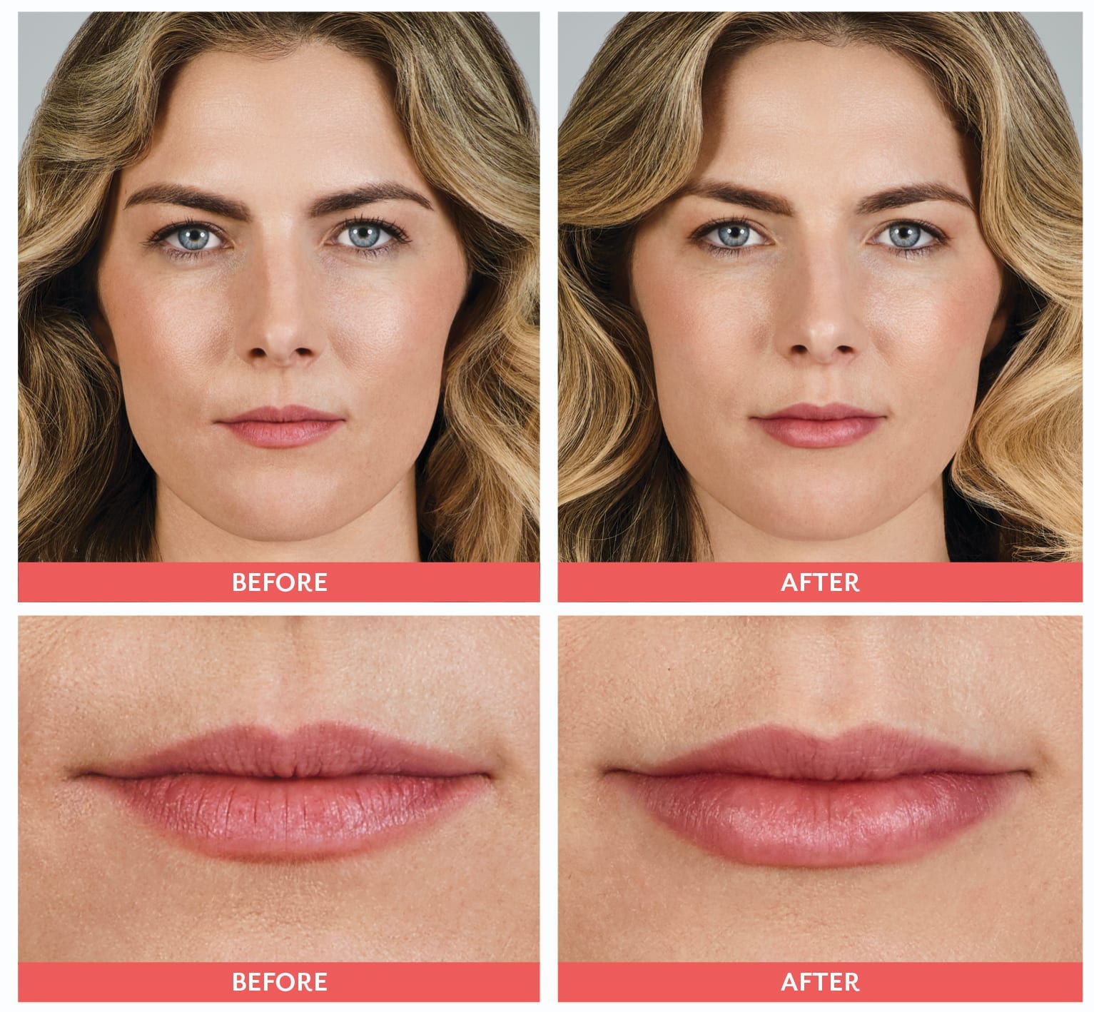 Juvederm Treatment | Vitality Integrative Skin Clinic